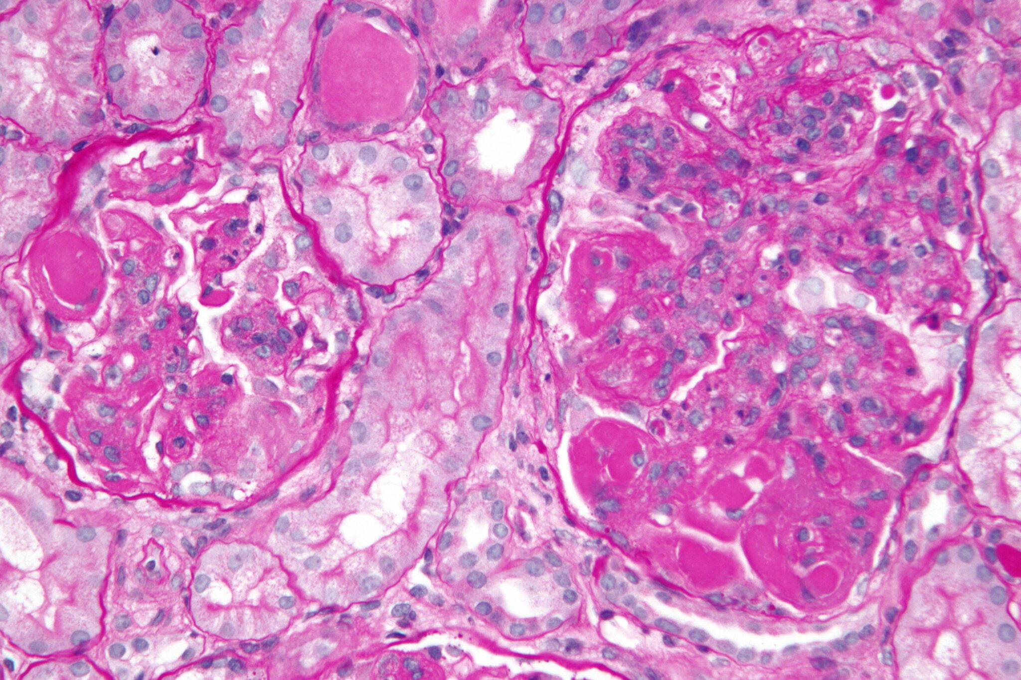 SLE with kidney damage does not always have to be lupus nephritis ...