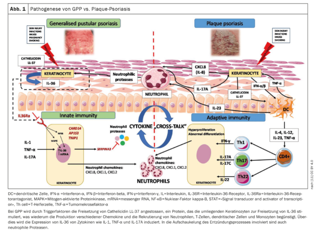 Successful treatment of an acute GPP flare-up - Medizinonline
