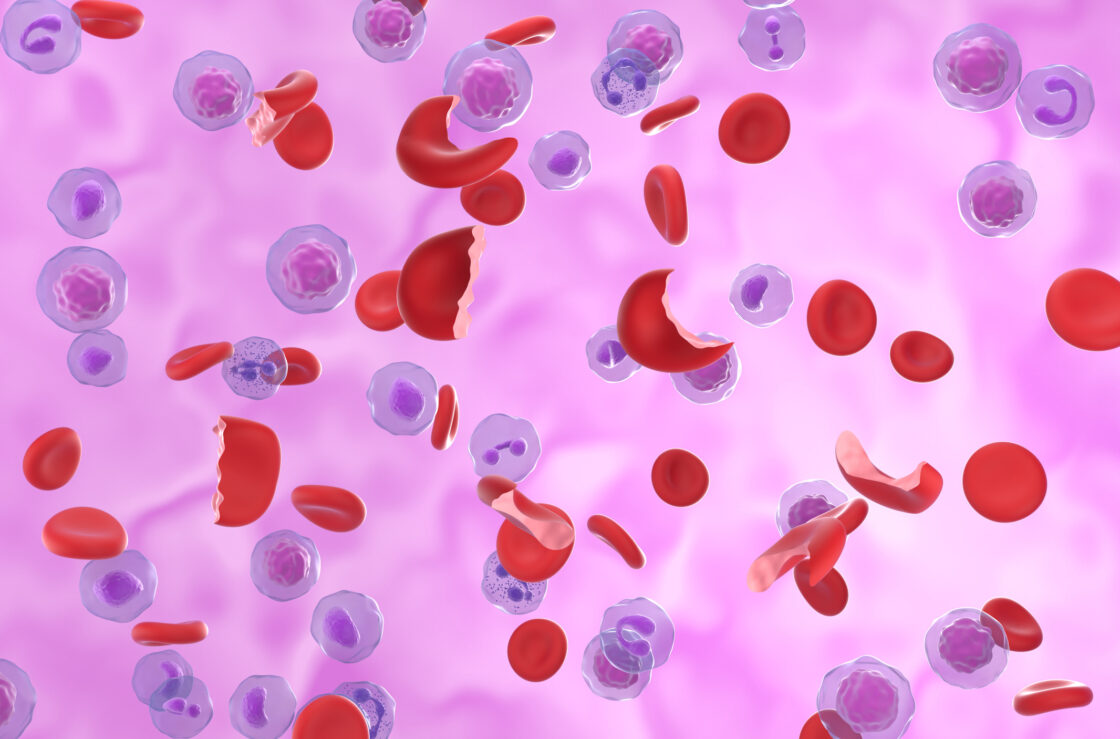 L'anémie microcytaire hypochrome est la plus fréquente - Medizinonline