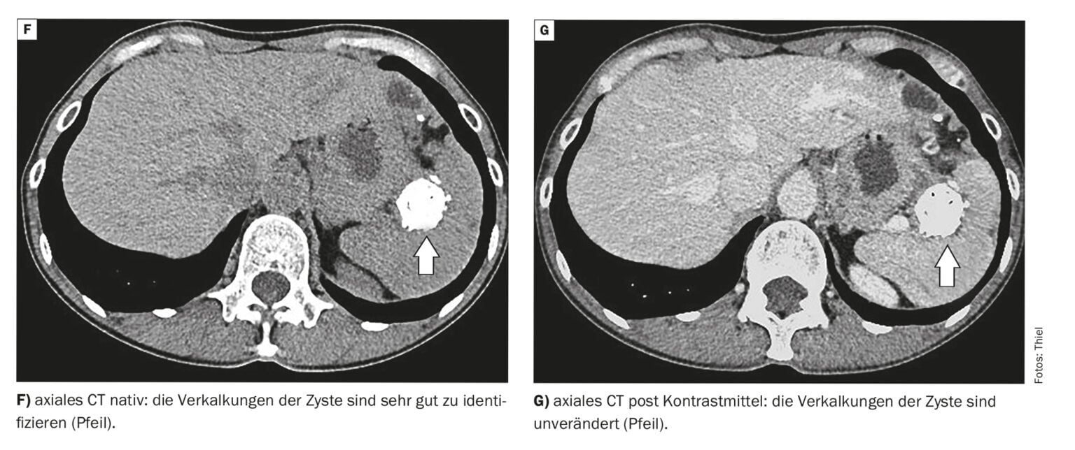 Abdominal pain - Splenic cyst - Medizinonline