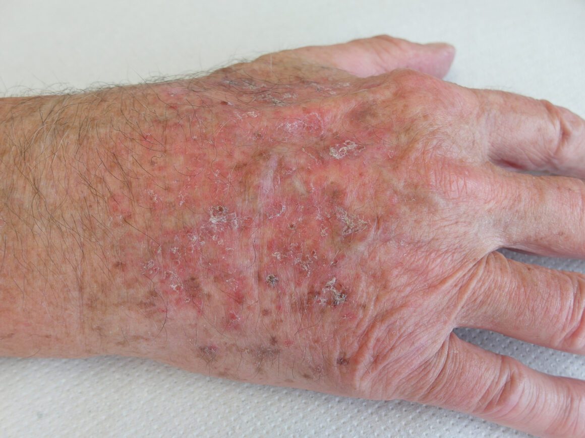 Guideline with updated treatment recommendations - Medizinonline