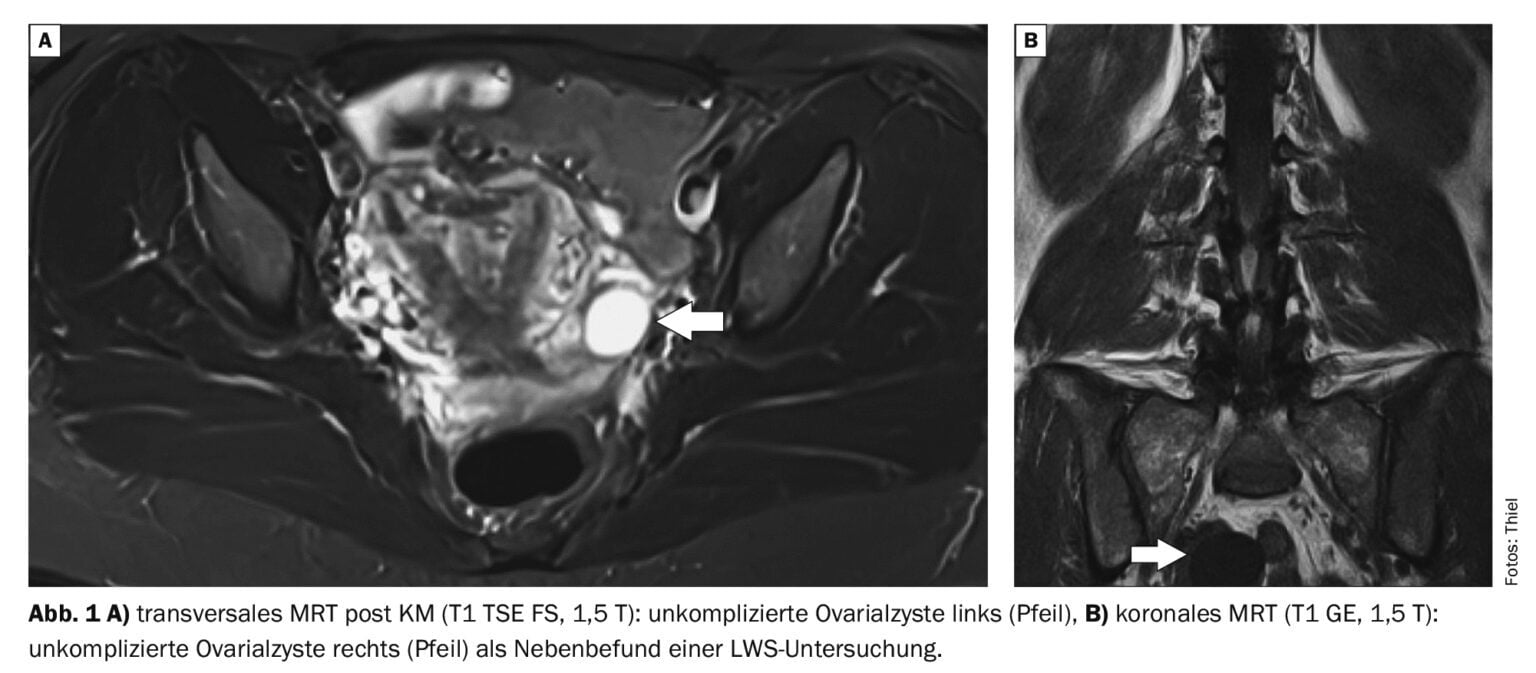 Abdominal pain - Ovarian cysts - Medizinonline