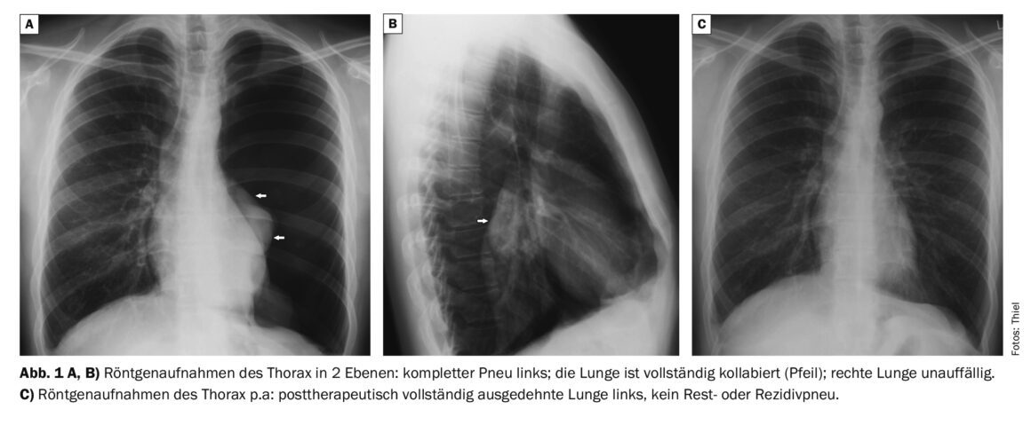 Troubles pulmonaires - Pneumothorax - Medizinonline