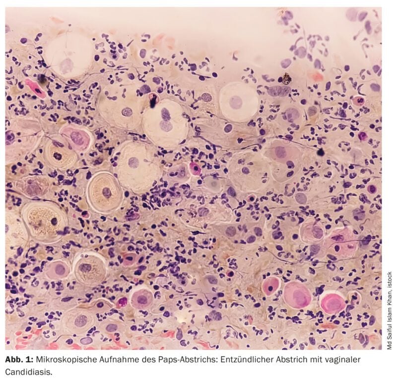 Phytotherapy for vulvovaginal candidiasis - Medizinonline