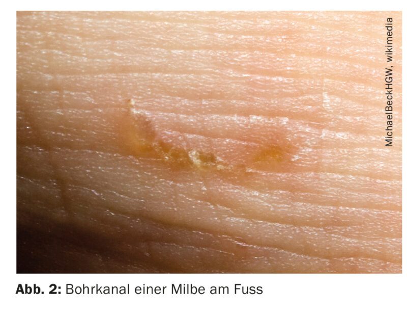 Successful anti-scabiosis treatment - current recommendations ...