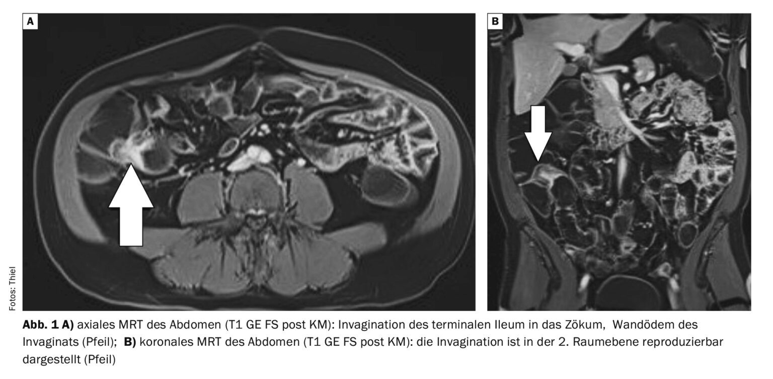 Abdominal pain - intussusception and other displacements of the bowel ...