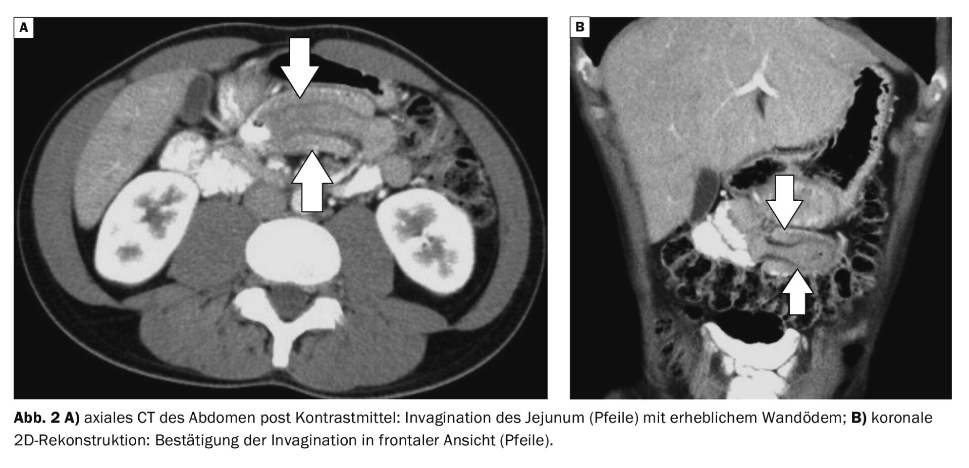 Abdominal pain - intussusception and other displacements of the bowel ...