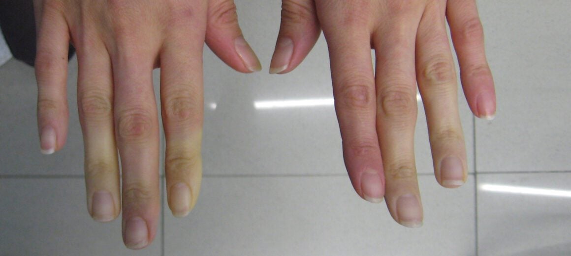 Calcinosis cutis als seltene Manifestation - Medizinonline