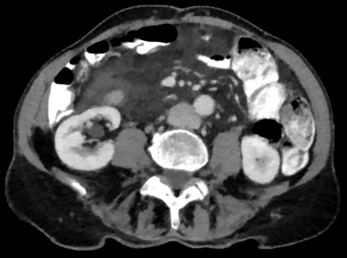 Abdominal pain - panniculitis - Medizinonline