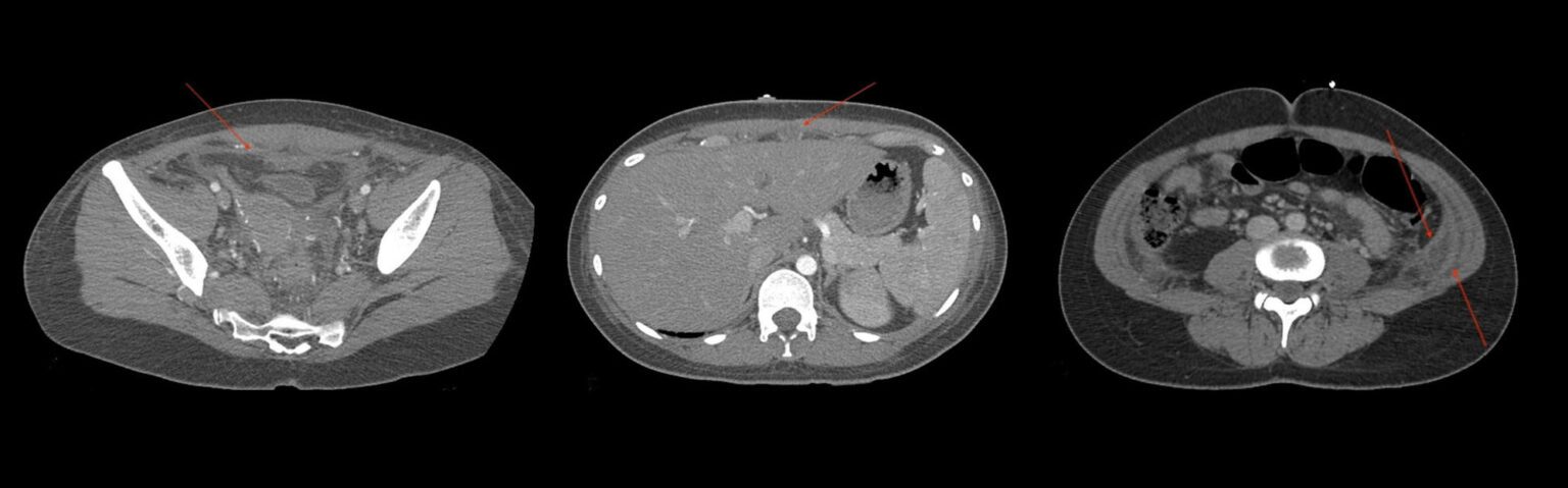 Le nuove raccomandazioni STRIDE II in pratica: "Bisogna puntare in alto ...