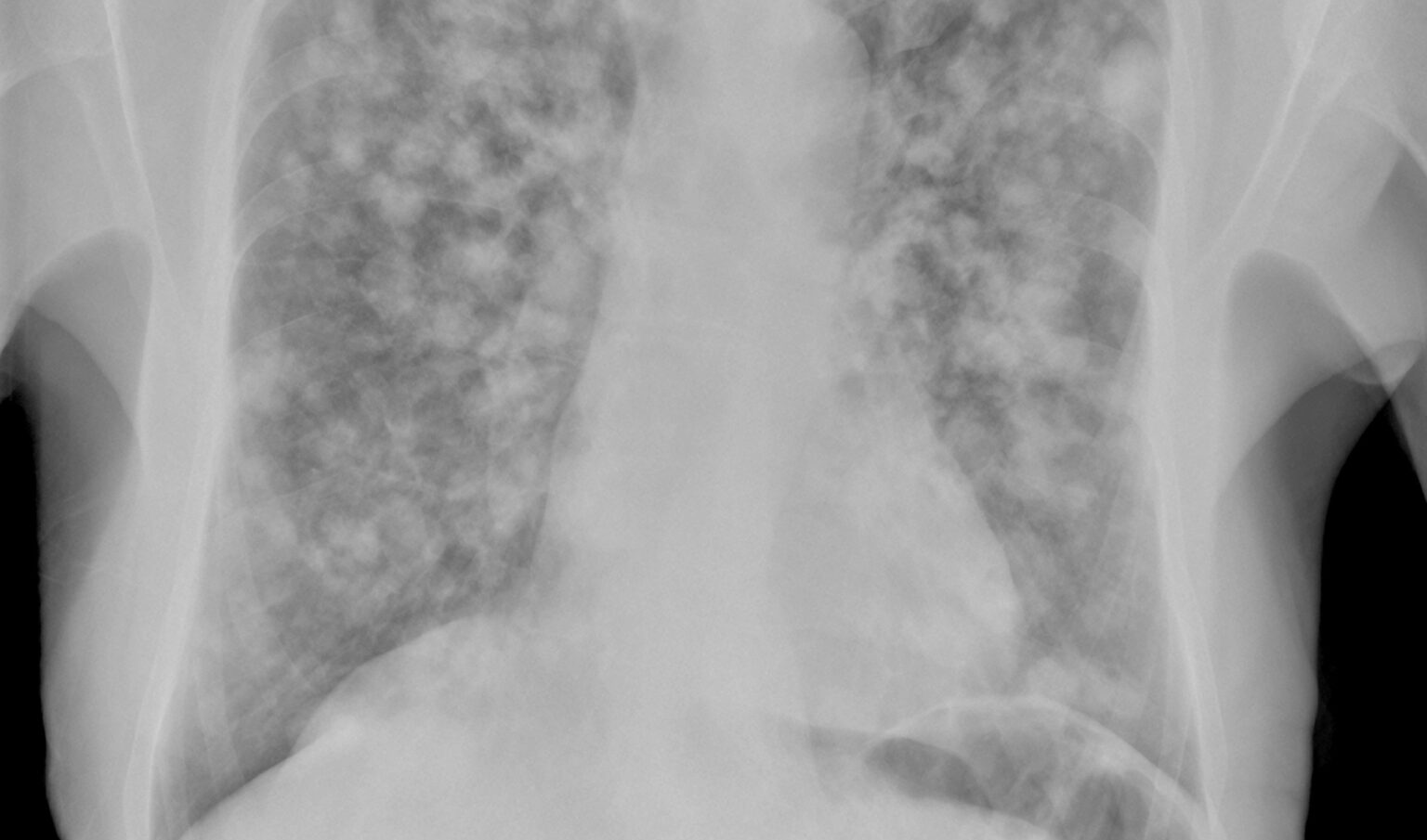 Los nuevos criterios de clasificación ACR/EULAR - Medizinonline