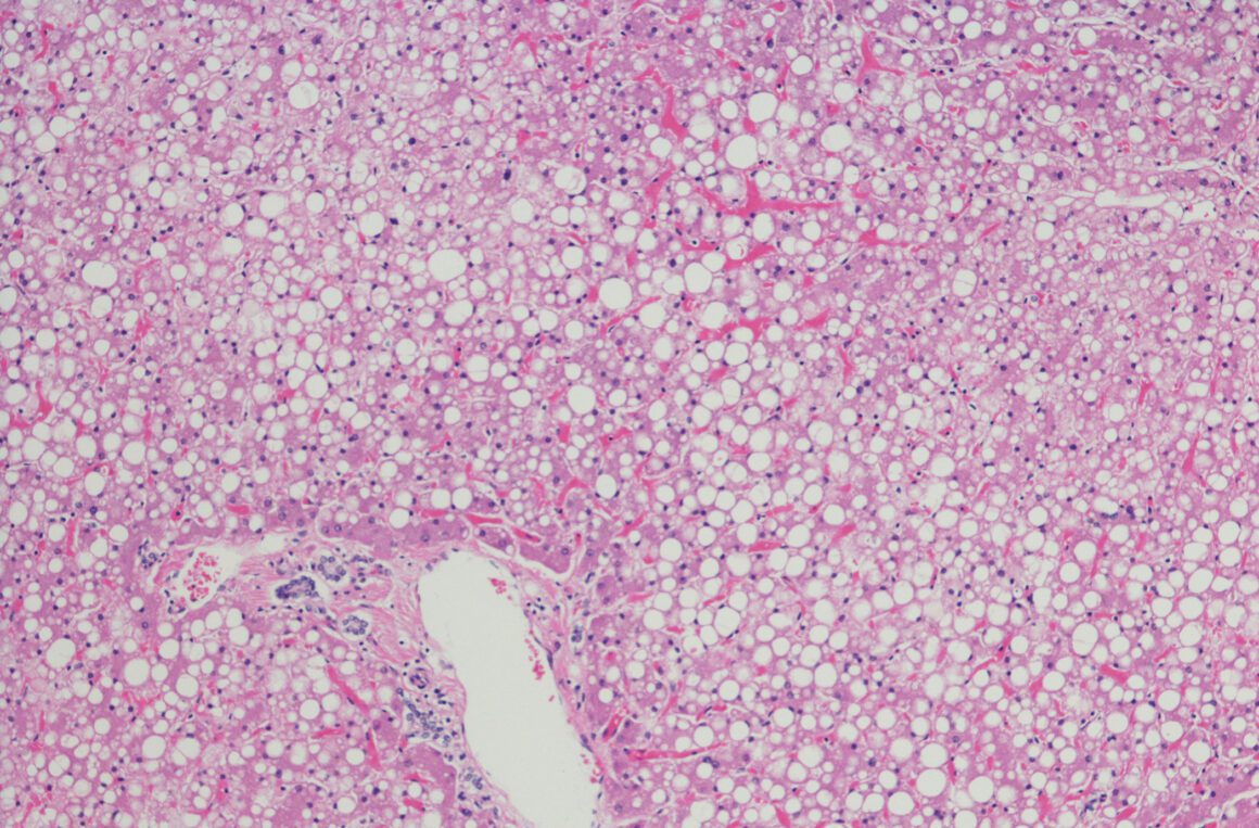 Syndrome de l'agglutinine froide - Medizinonline