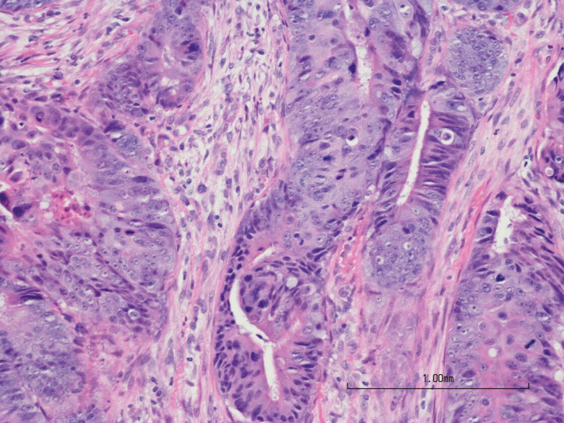 El pie diabético infectado - diagnóstico y tratamiento - Medizinonline