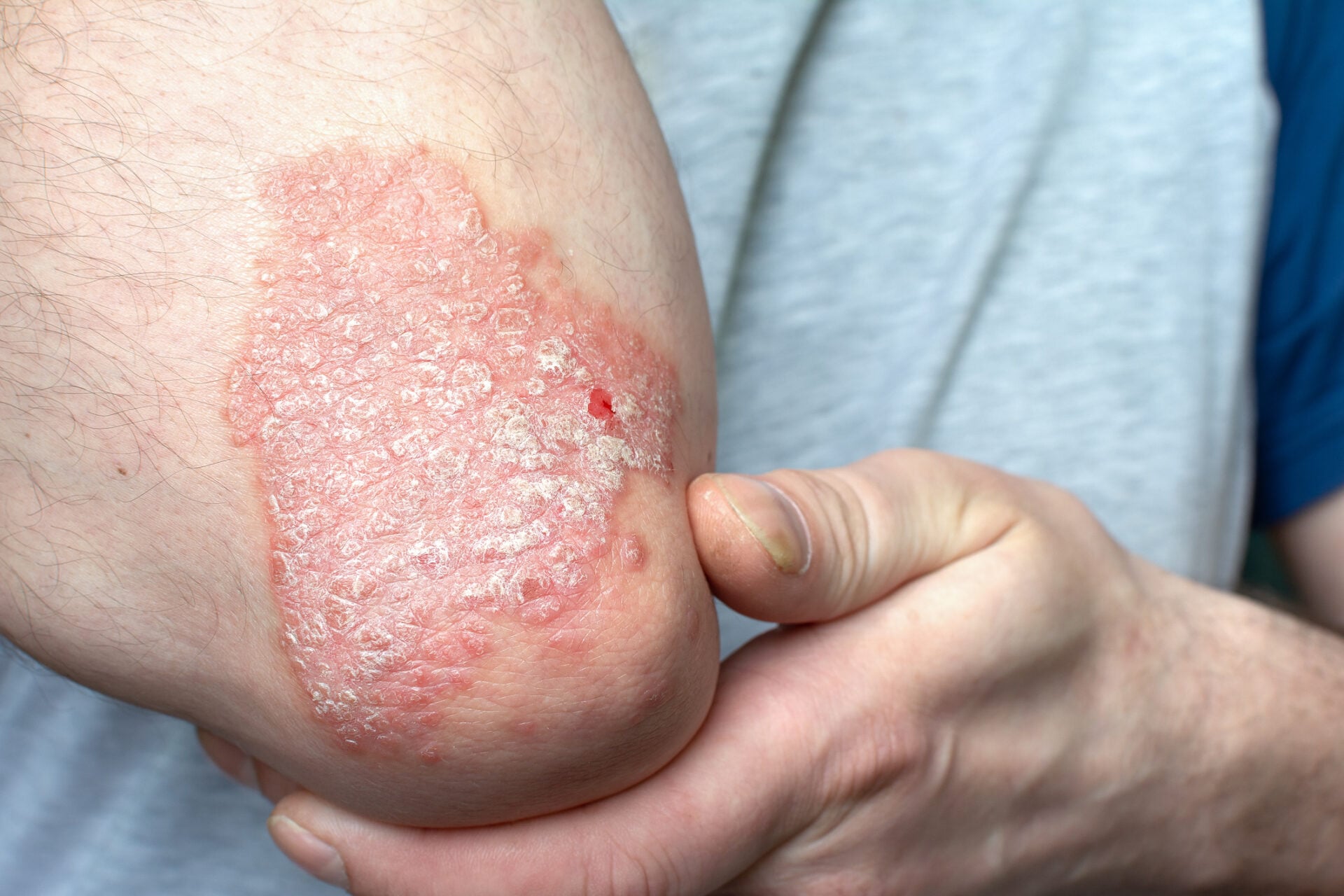 Anévrisme de l'artère splénique chez la femme : Clinique, diagnostic et ...